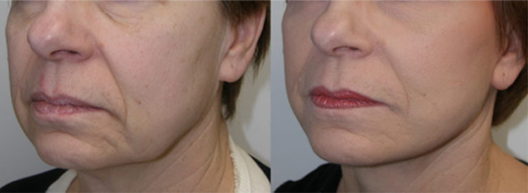 Droopy Jawls – ISO Metrik