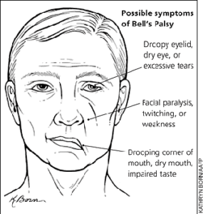 Facial Palsy – ISO Metrik